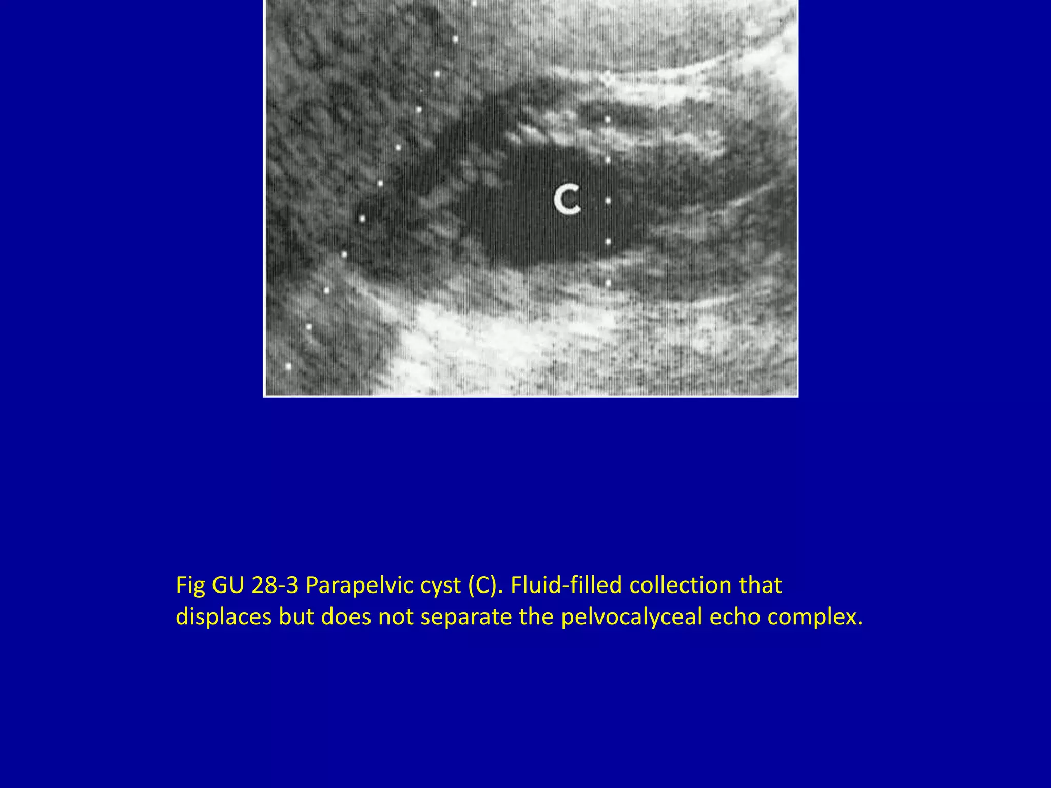 28 anechoic (cystic) renal masses | PPTX