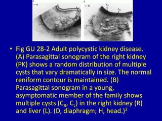 28 anechoic (cystic) renal masses | PPTX
