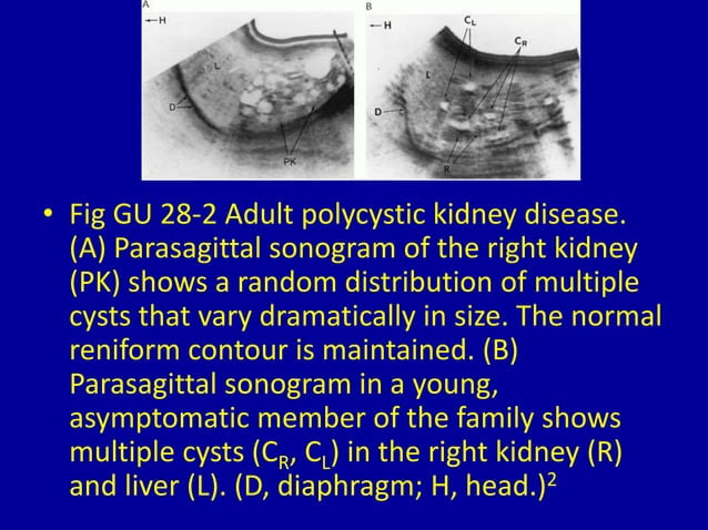 28 anechoic (cystic) renal masses | PPT