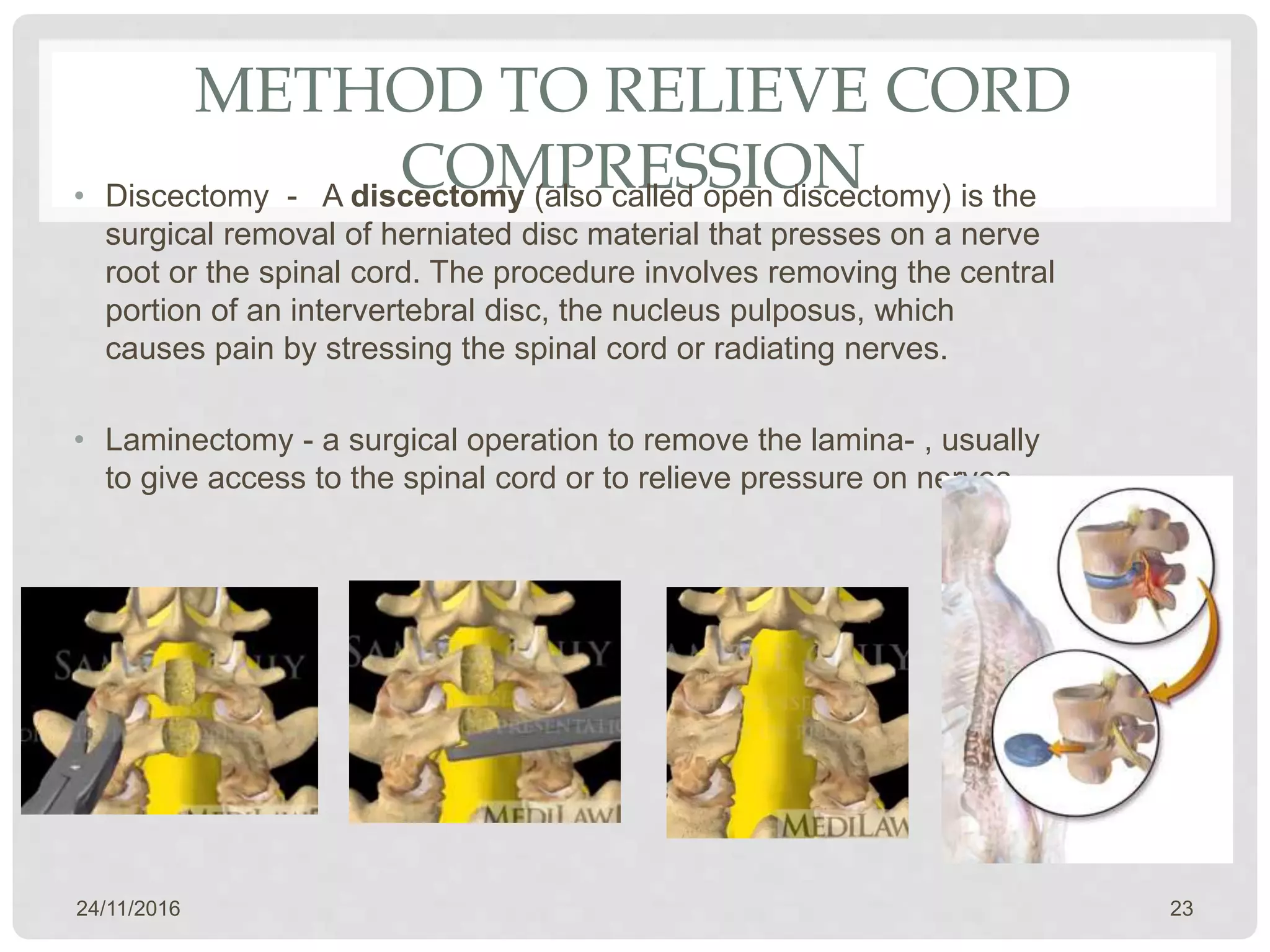 CAUDA EQUINA VS CONUS MEDULLARIS SYNDROME | PPTX