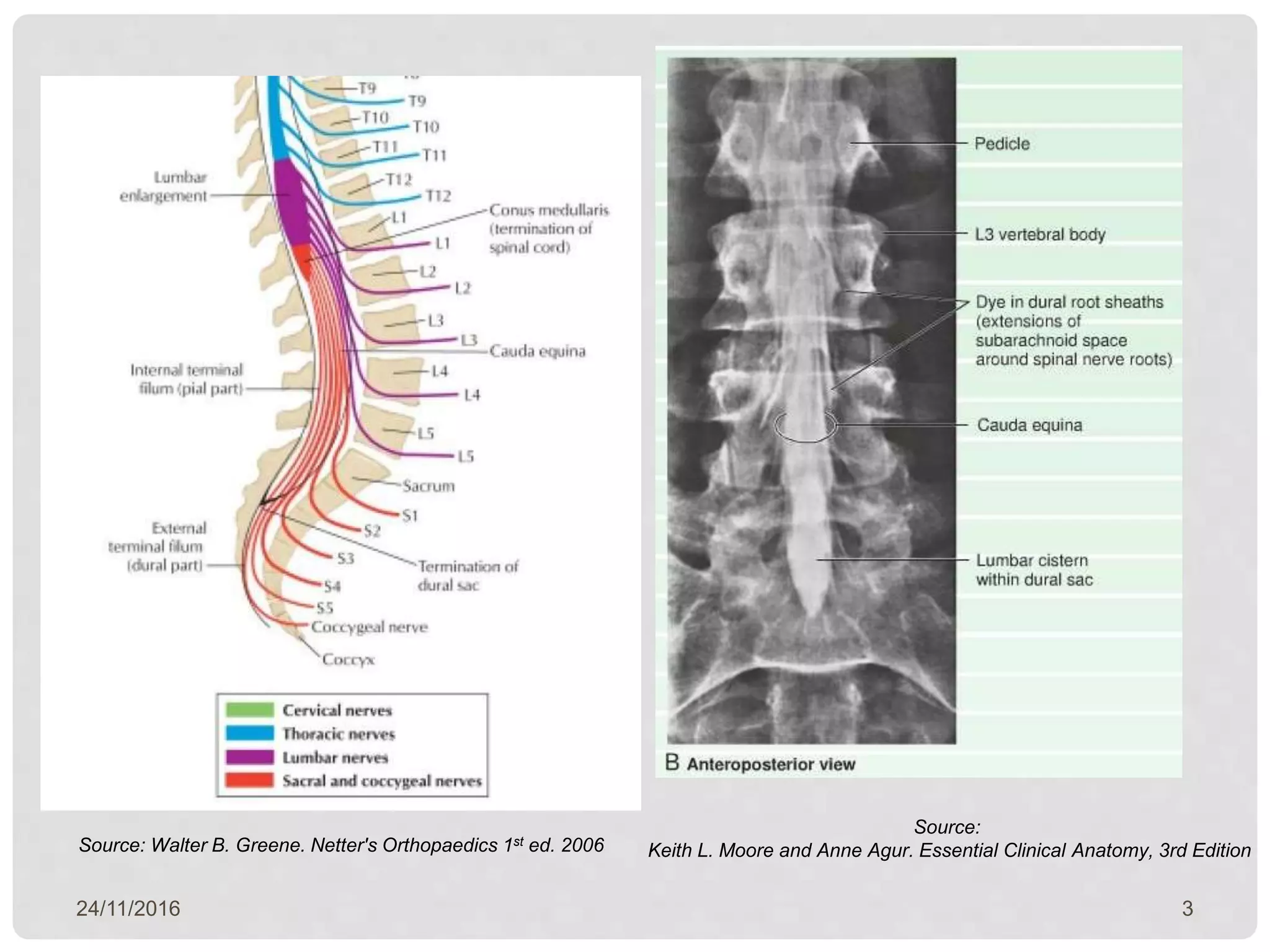 CAUDA EQUINA VS CONUS MEDULLARIS SYNDROME | PPTX