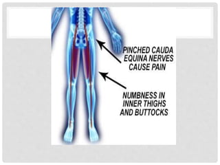 CAUDA EQUINA VS CONUS MEDULLARIS SYNDROME | PPTX