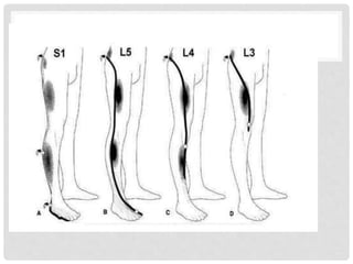 CAUDA EQUINA VS CONUS MEDULLARIS SYNDROME | PPTX
