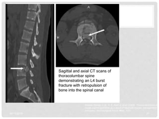 CAUDA EQUINA VS CONUS MEDULLARIS SYNDROME | PPTX