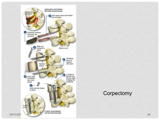 CAUDA EQUINA VS CONUS MEDULLARIS SYNDROME | PPTX