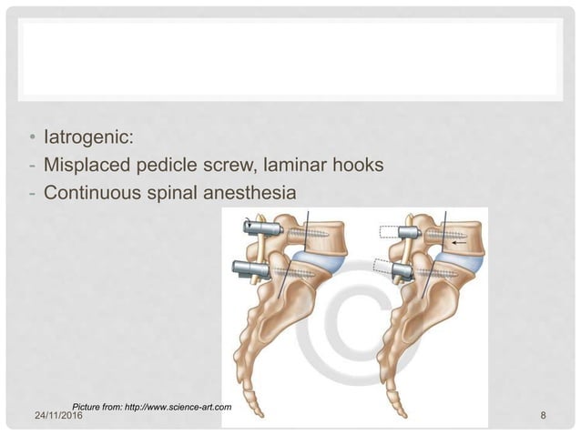 CAUDA EQUINA VS CONUS MEDULLARIS SYNDROME | PPTX | Death, Injury, or ...