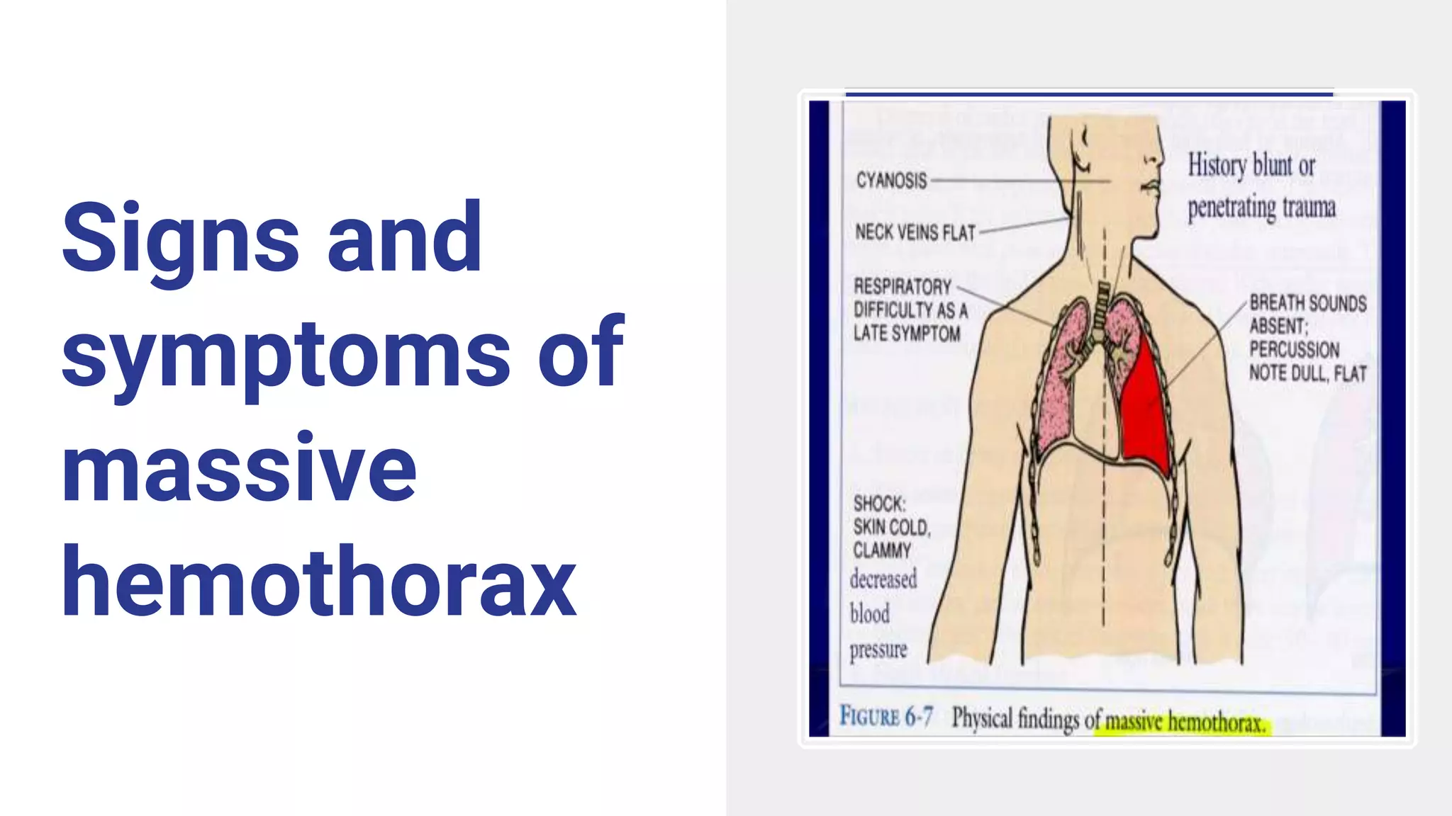 massive hemothorax | PPTX