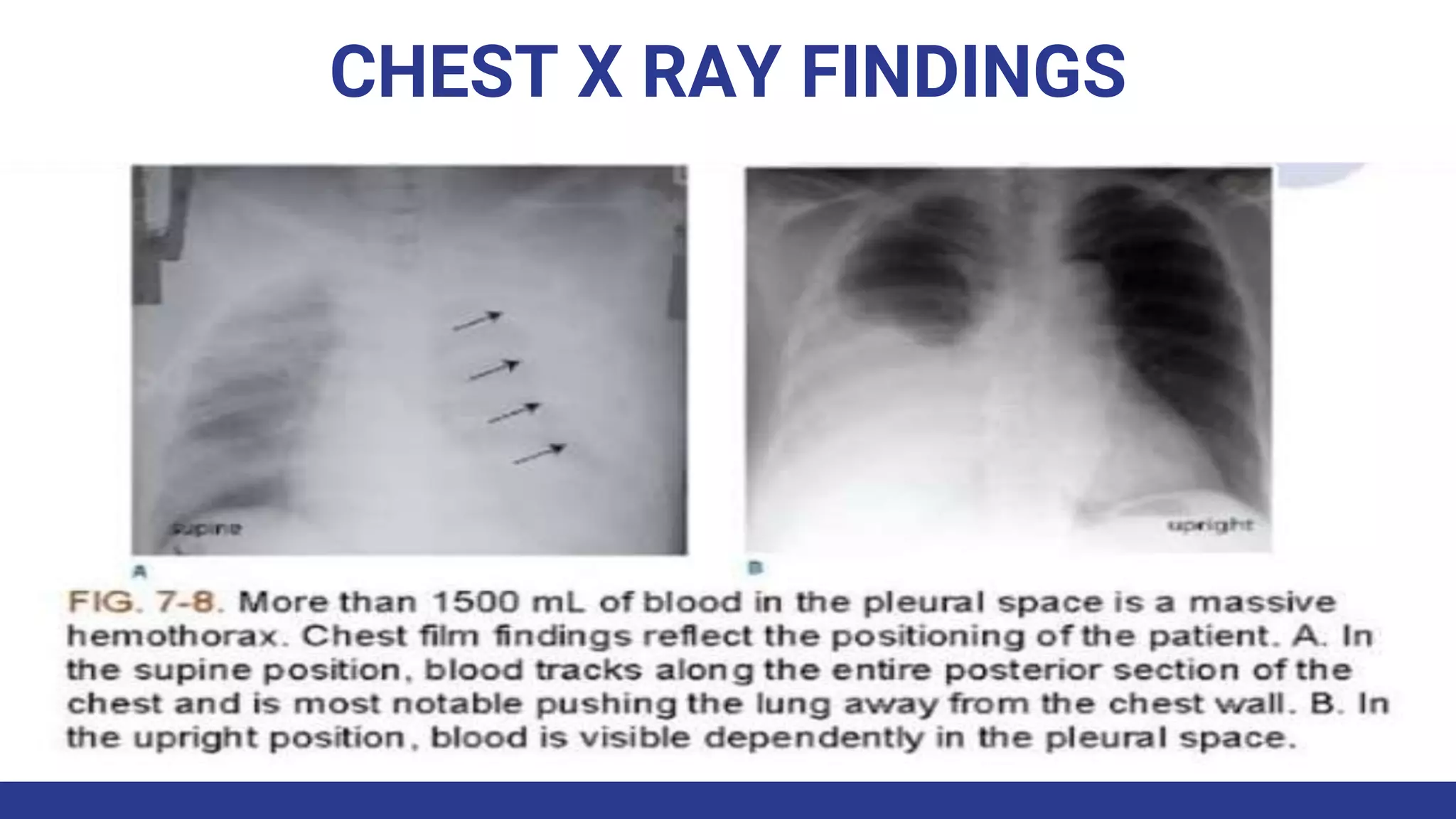 massive hemothorax | PPTX