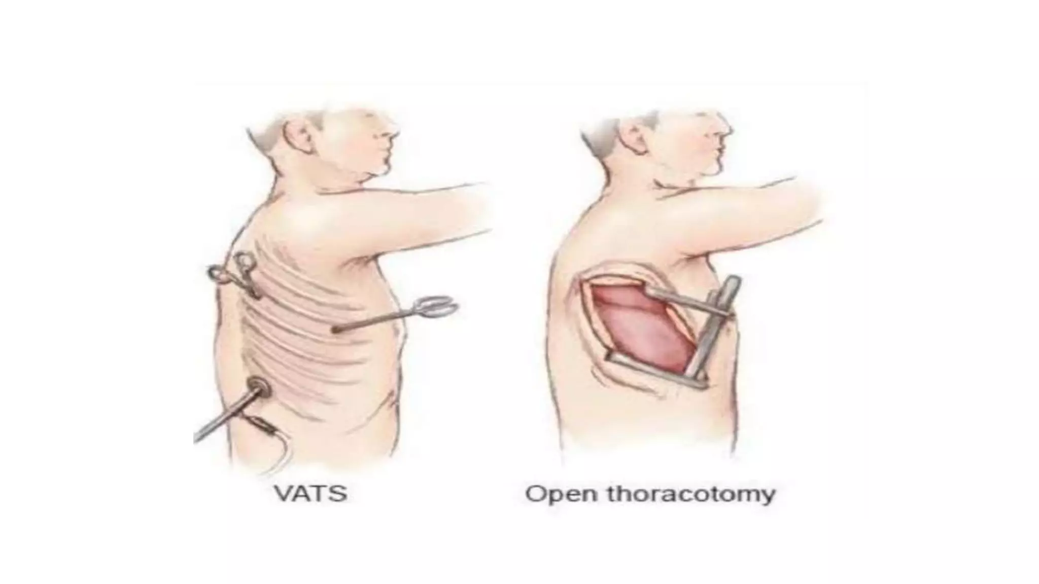 Massive Hemothorax Pptx