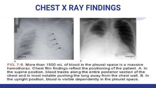 Chest X Ray Hemothorax