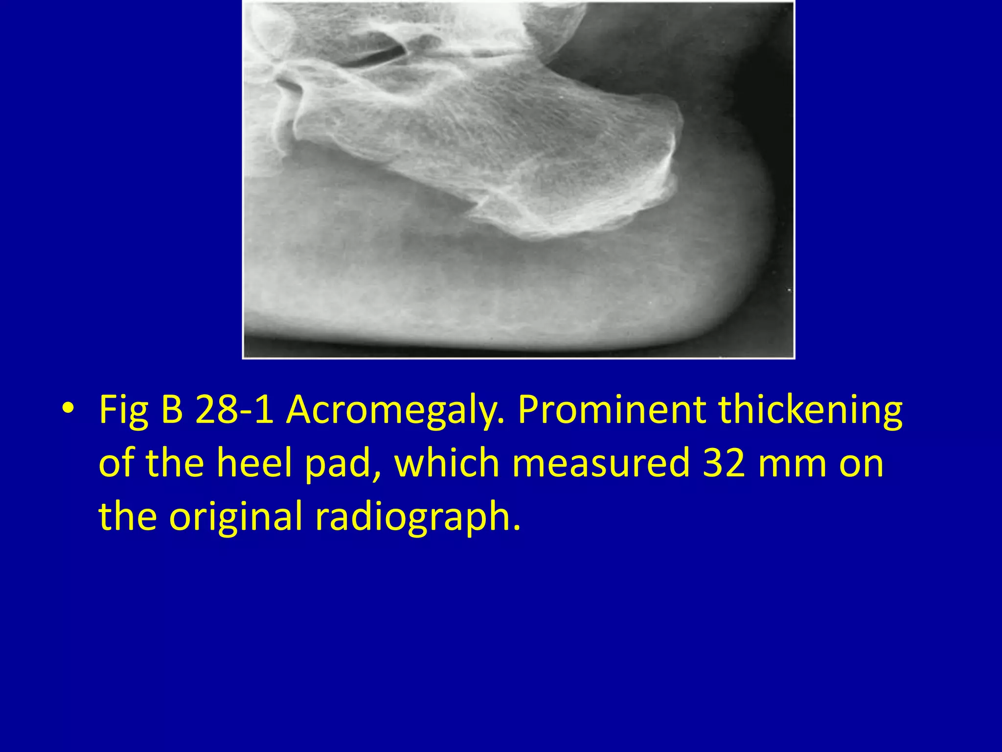 28 heel pad thickening ( | PPTX | Foot Health | Diseases and Conditions