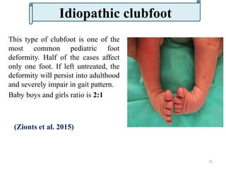 Clubfoot and stage wise management of children.pptx
