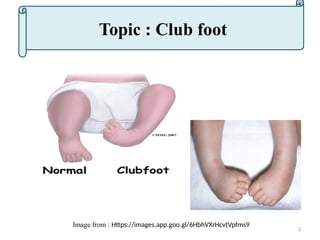 Clubfoot and stage wise management of children.pptx