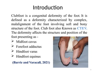 Clubfoot and stage wise management of children.pptx