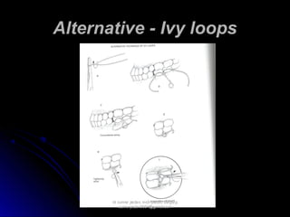 mandibular fractures | PPT