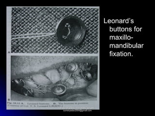 mandibular fractures | PPT