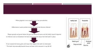 28 Periodontitis new.,best ppt for understanding and notes | PPTX