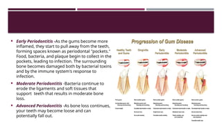 28 Periodontitis new.,best ppt for understanding and notes | PPTX