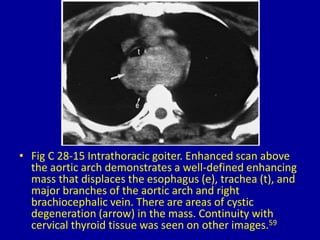 28 posterior mediastinal lesions on computed tomography | PPT