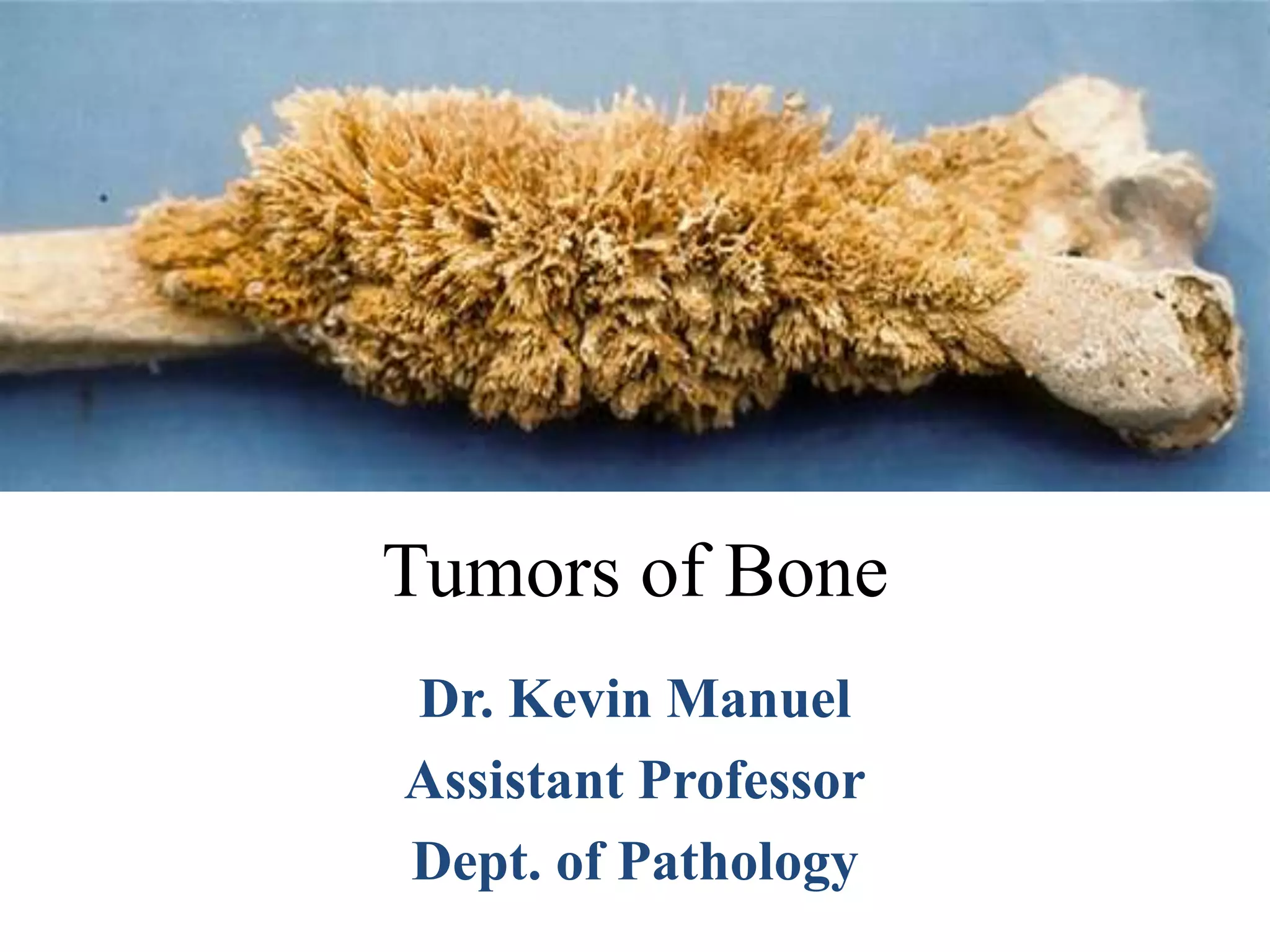 Tumors of bone | PPTX