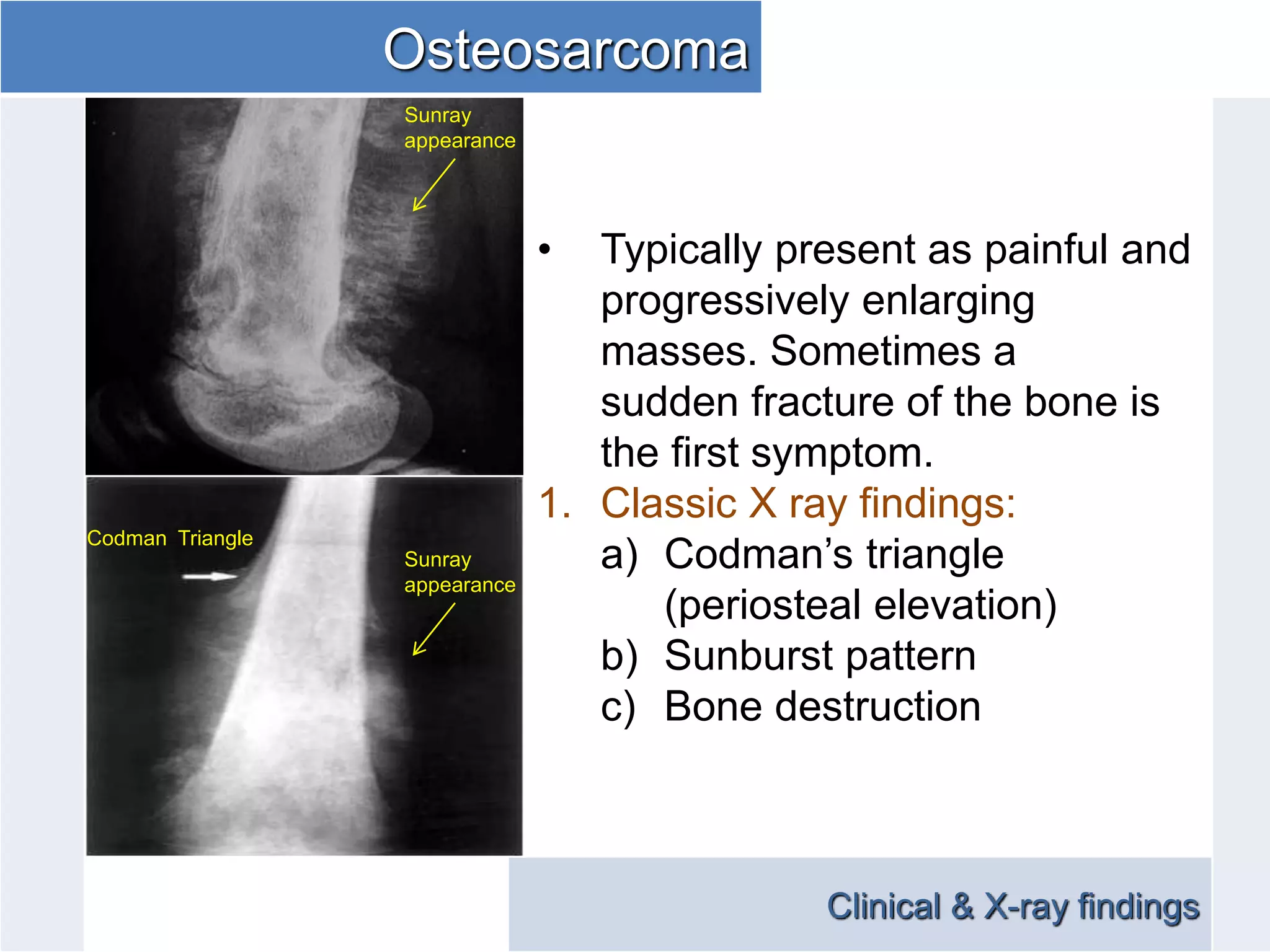 Tumors of bone | PPTX