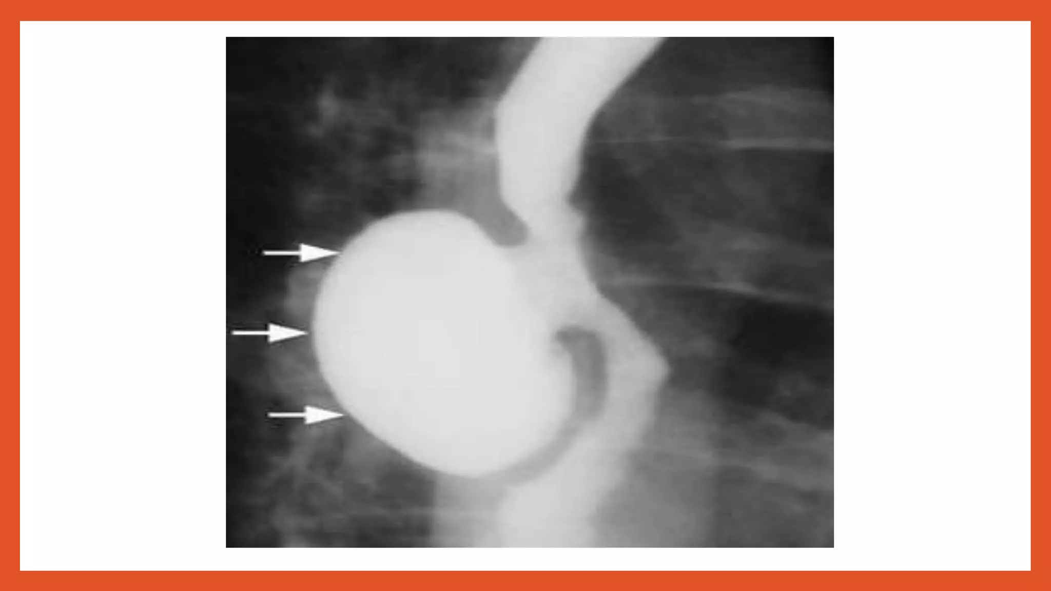 Esophageal diseases, Gastroesophageal reflux disease (GERD) | PPTX