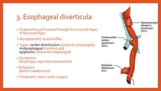 Esophageal diseases, Gastroesophageal reflux disease (GERD) | PPTX