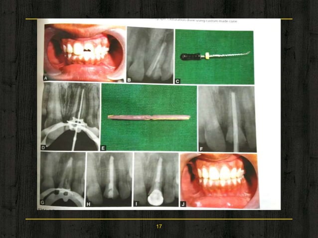 TECHNIQUES OF OBTURATION | PPTX