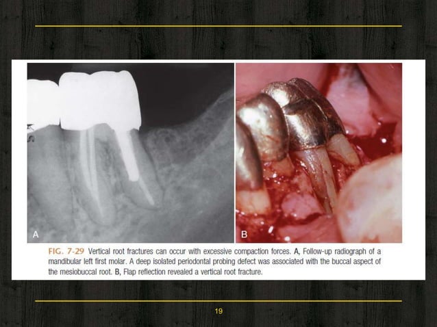 TECHNIQUES OF OBTURATION | PPTX