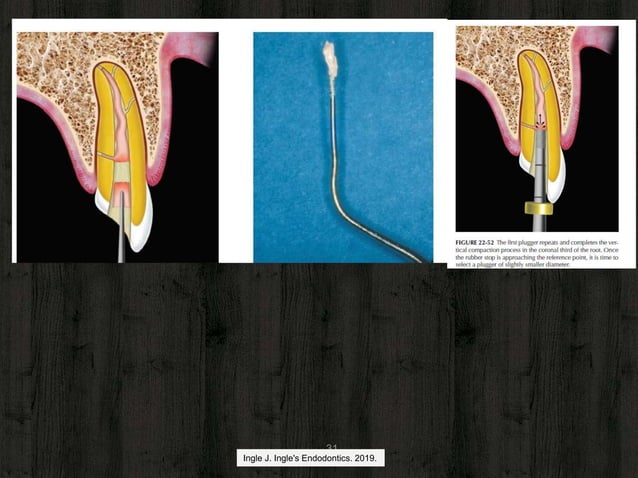 TECHNIQUES OF OBTURATION | PPTX