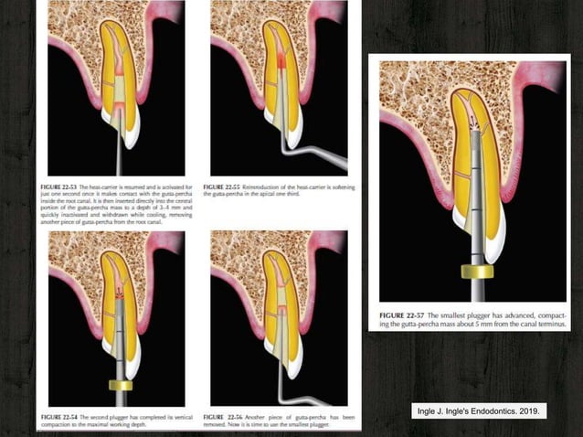 TECHNIQUES OF OBTURATION | PPTX