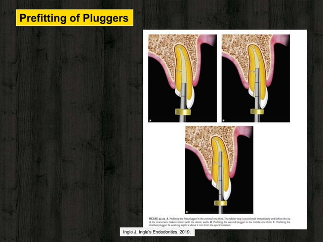 TECHNIQUES OF OBTURATION