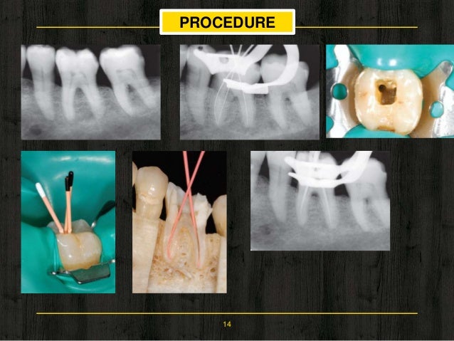 TECHNIQUES OF OBTURATION