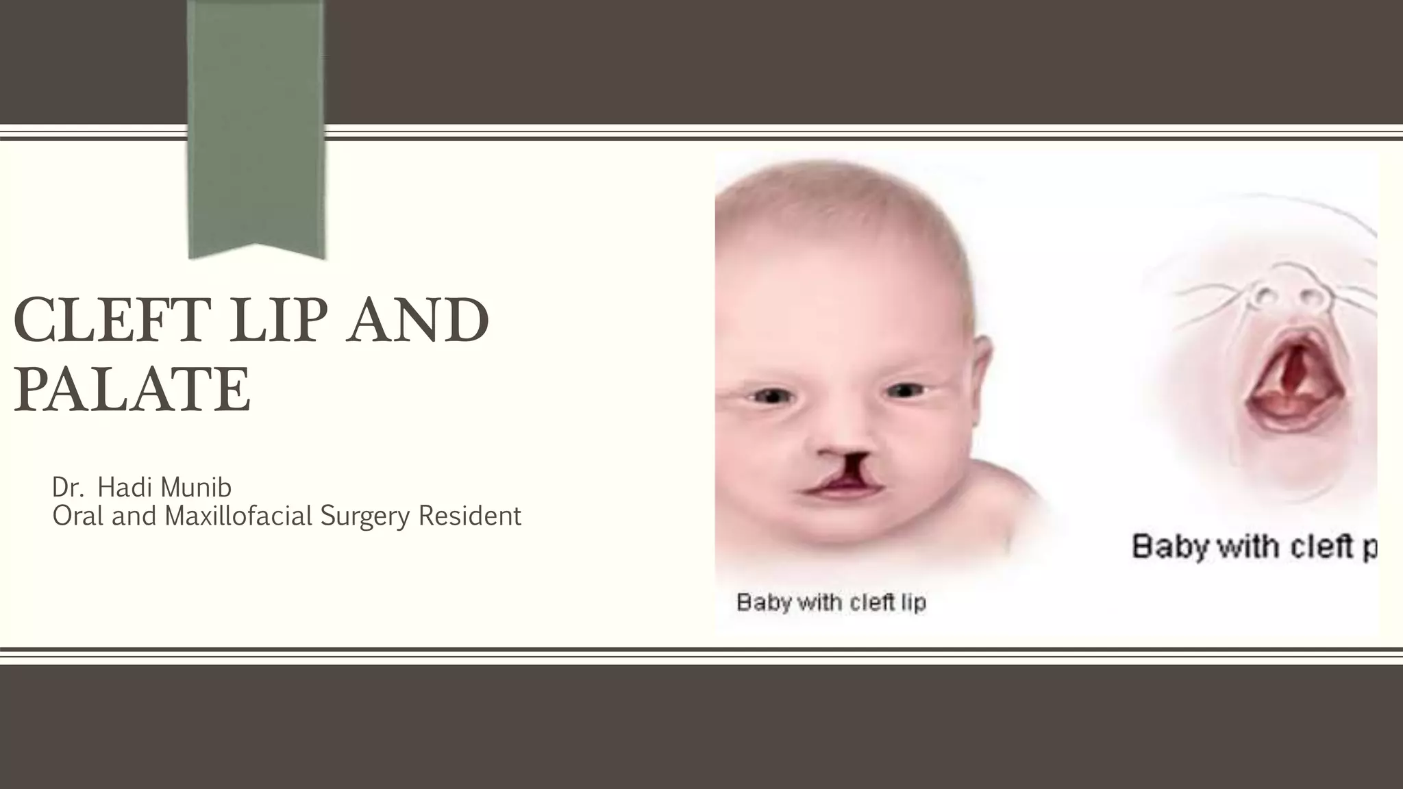 Cleft Lip and Palate | PPTX