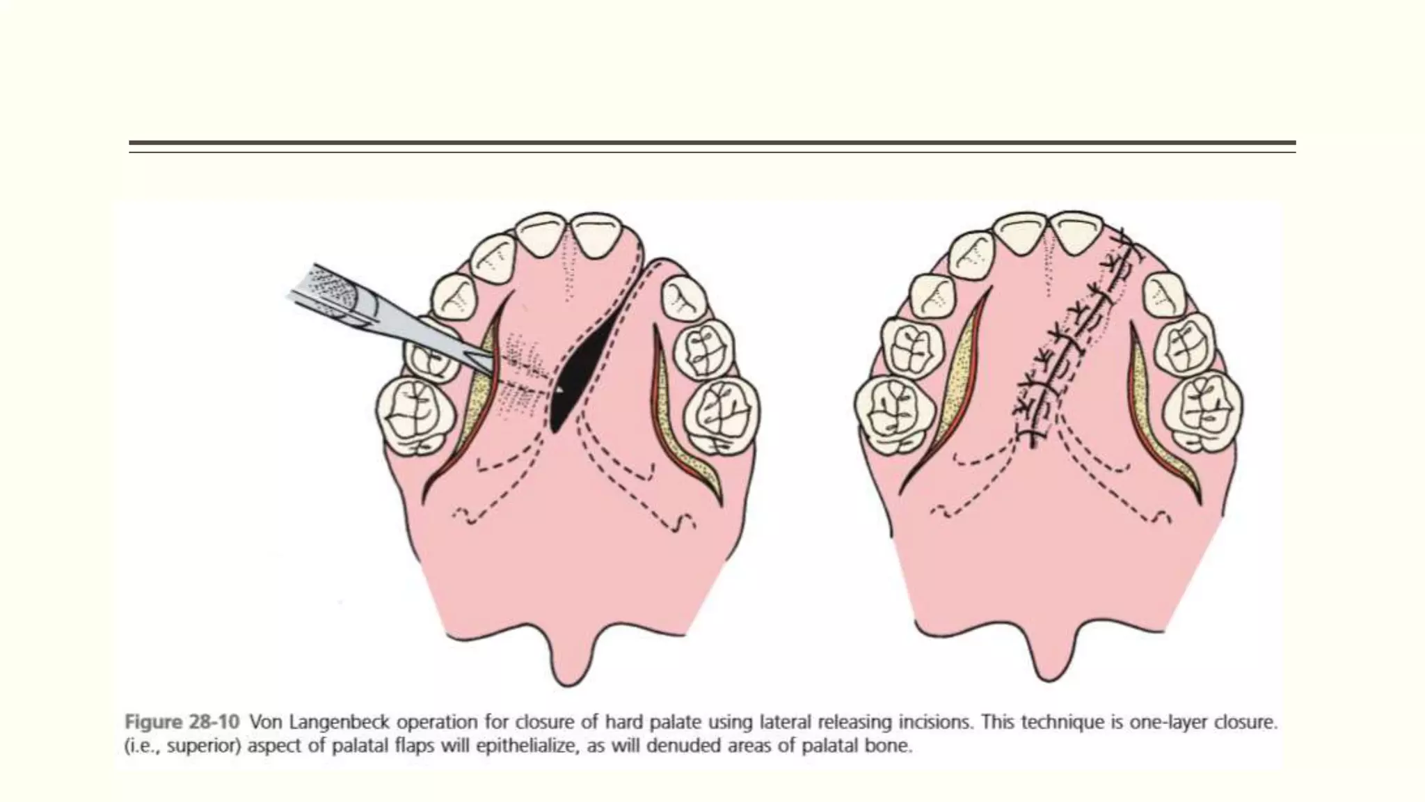Cleft Lip and Palate | PPTX