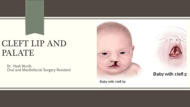 Cleft Lip and Palate | PPTX
