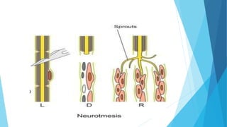 29. Peripheral nerve injury.pptx
