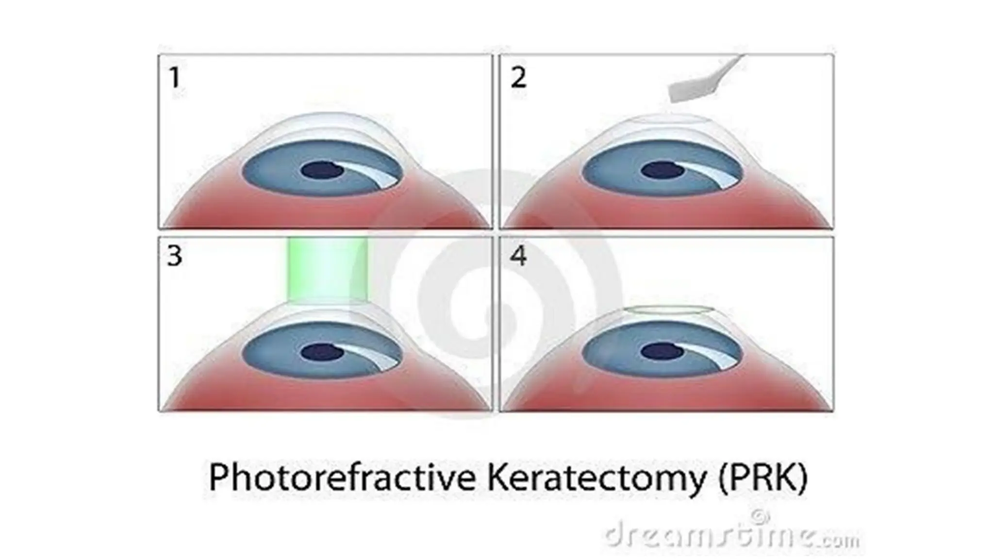 29. Refractive surgery in ophthalmology by rahul dai.pptx