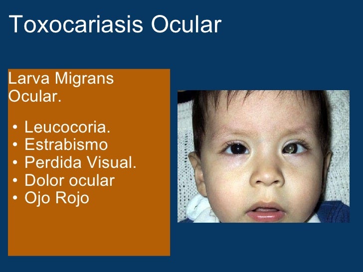 Ocular Larva Migrans.