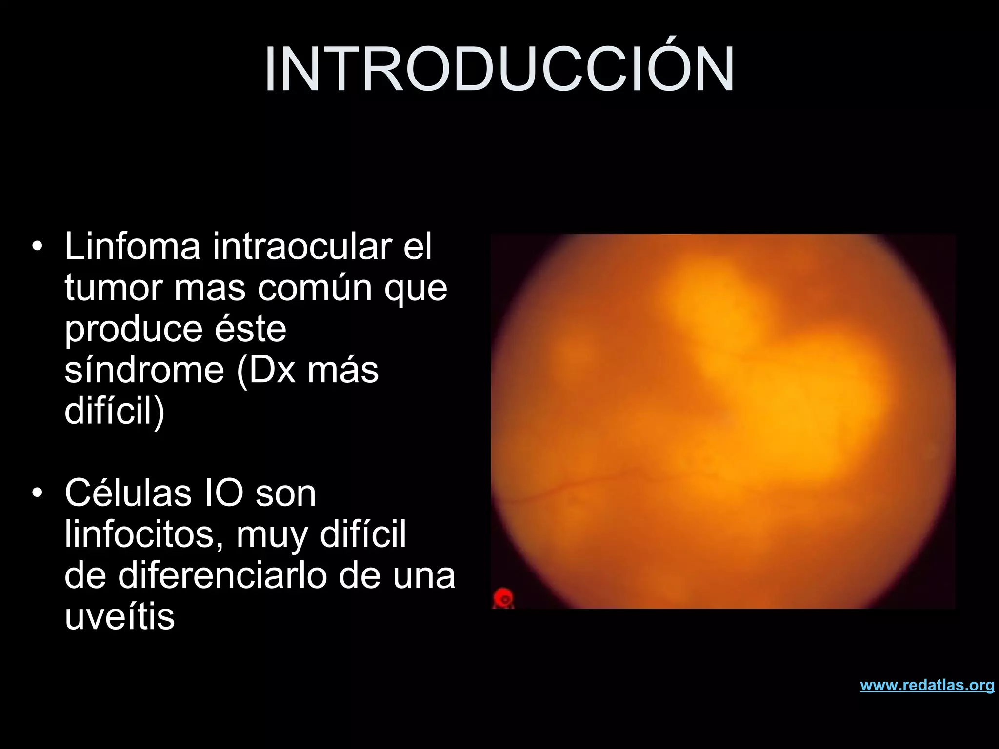 LINFOMA INTRAOCULAR | PPT