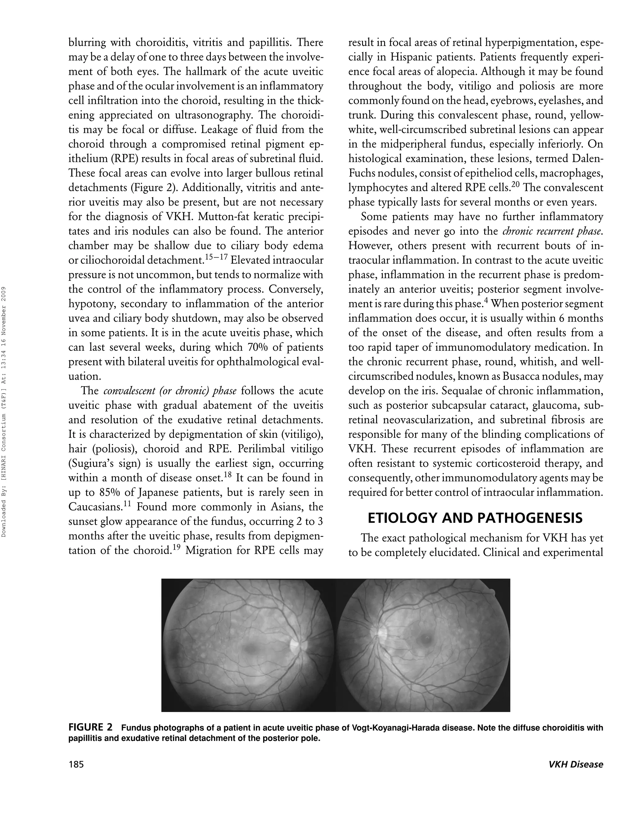 Vogt-Koyanagi-Harada Disease | PDF