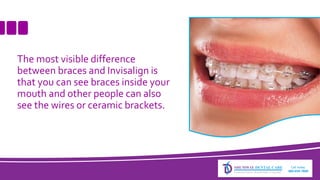 The visible difference between invisalign and braces | PPT