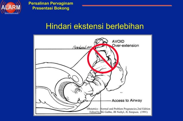 persalian pervaginam presentasi letak bokong | PPT