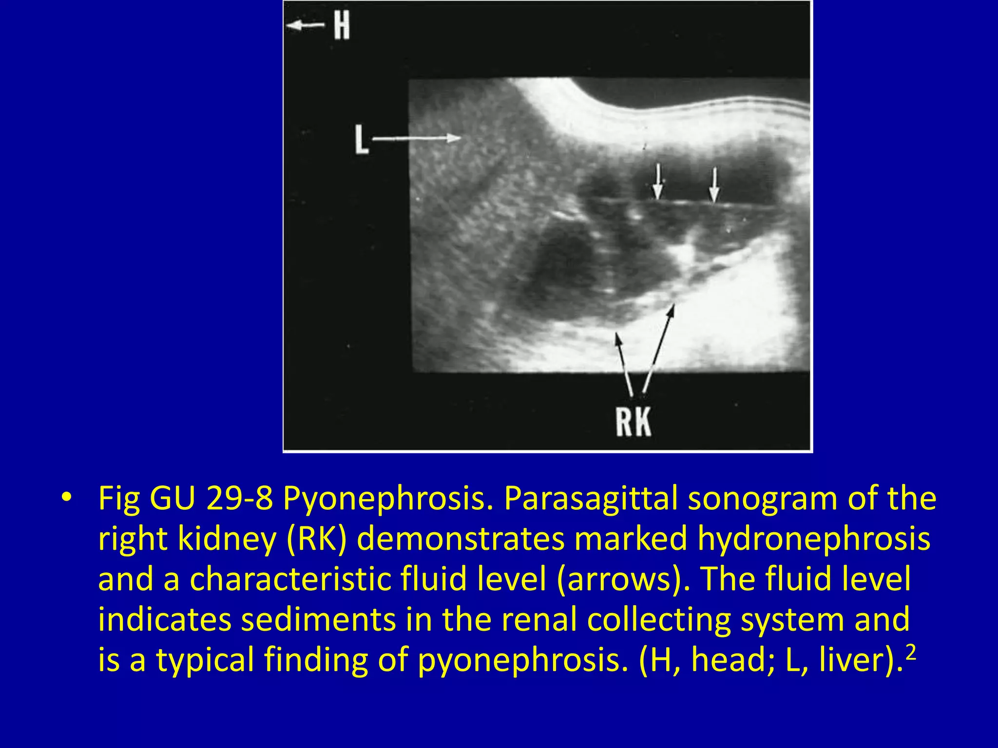 29 complex renal masses | PPTX