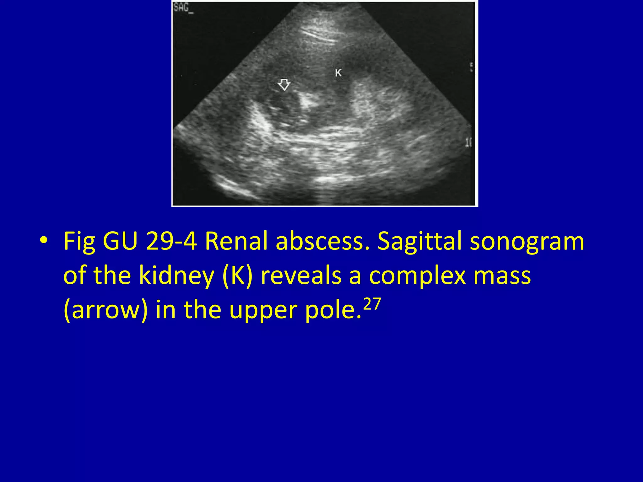 29 complex renal masses | PPTX