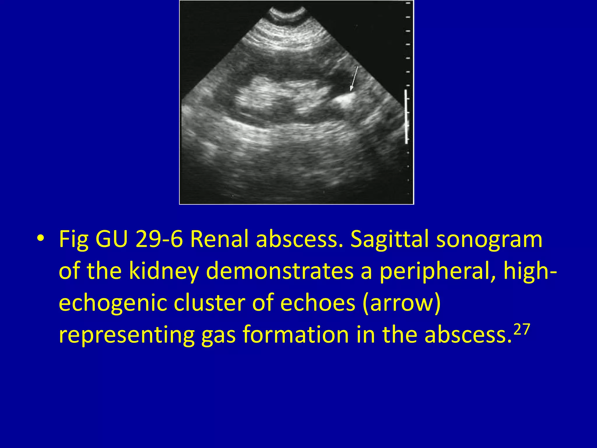 29 complex renal masses | PPTX