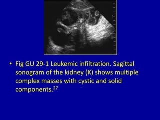 29 complex renal masses | PPTX