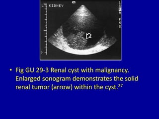 29 complex renal masses | PPTX