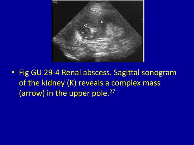 29 complex renal masses | PPT