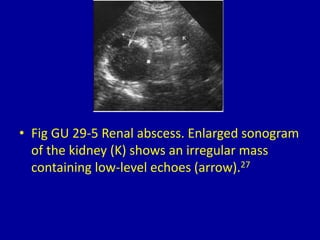 29 complex renal masses | PPTX